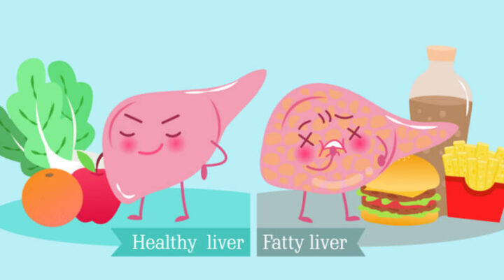 How to Know If I Have Fatty Liver | CARiNG Pharmacy