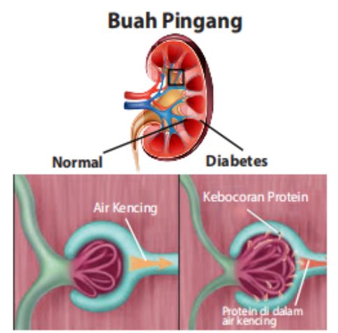 Diabetes Punca Kegagalan Buah Pinggang | CARiNG Pharmacy